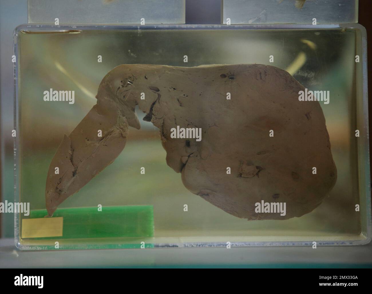 This Sept. 7, 2016 photo shows a section of a preserved liver with ...