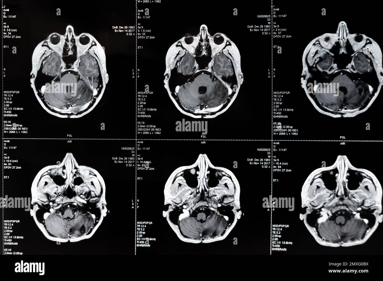Ct gehirntumor -Fotos und -Bildmaterial in hoher Auflösung – Alamy