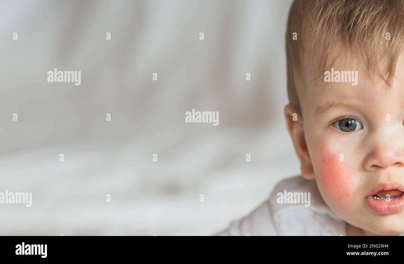 Atopische Dermatitis Ekzem in Baby.Condition, die die Haut zu rot ...