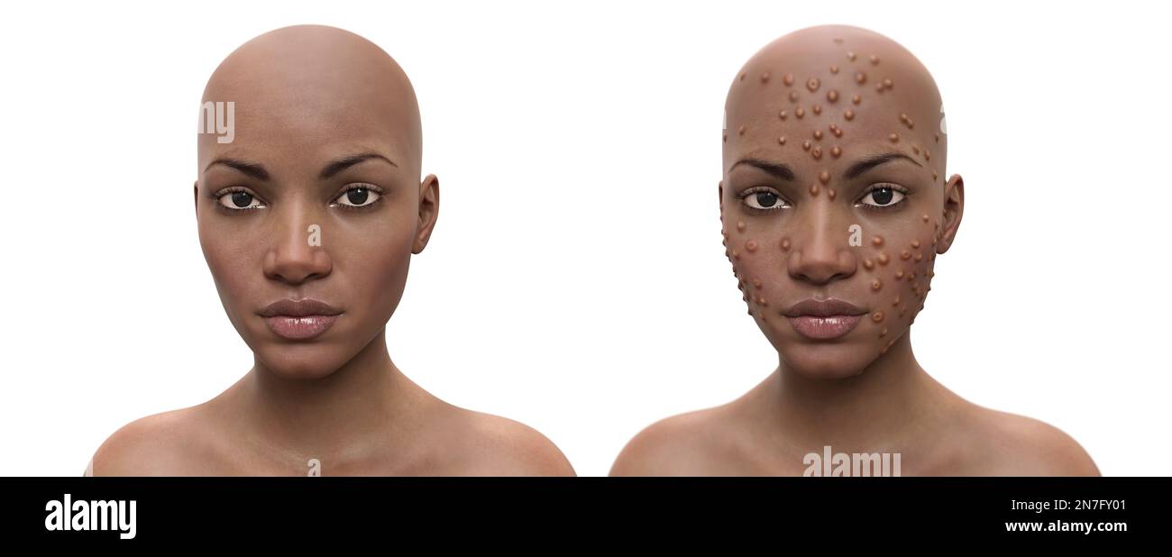 Affenpocken infektion Ausgeschnittene Stockfotos und -bilder - Alamy