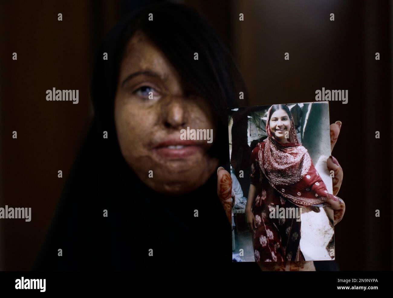 In this Tuesday, May 22, 2012 photo, Pakistani acid attack survivor ...