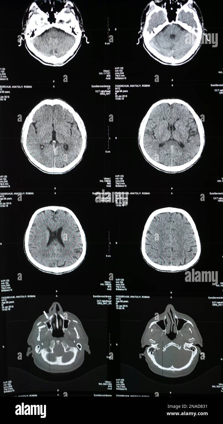Magnetresonanztomographie, MRT des menschlichen Gehirns nach Schädel ...