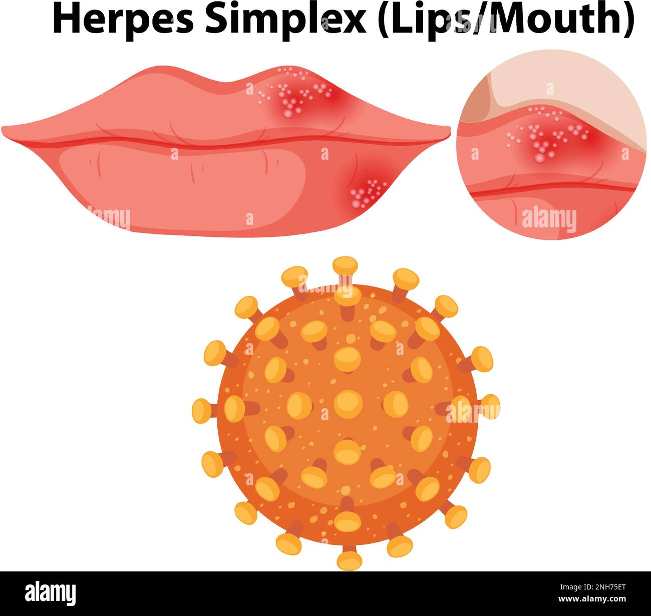 Herpes simplex virus vektoren -Fotos und -Bildmaterial in hoher Auflösung – Alamy
