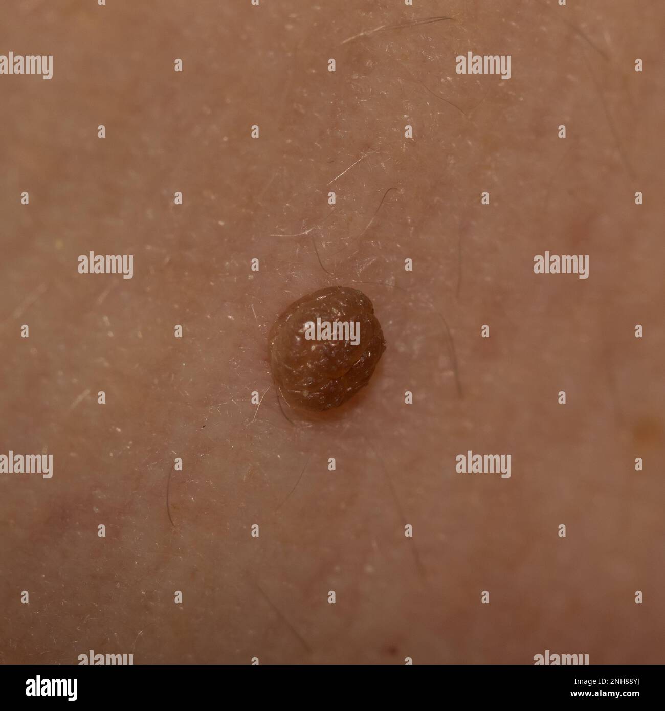 Epidermale bilder -Fotos und -Bildmaterial in hoher Auflösung – Alamy