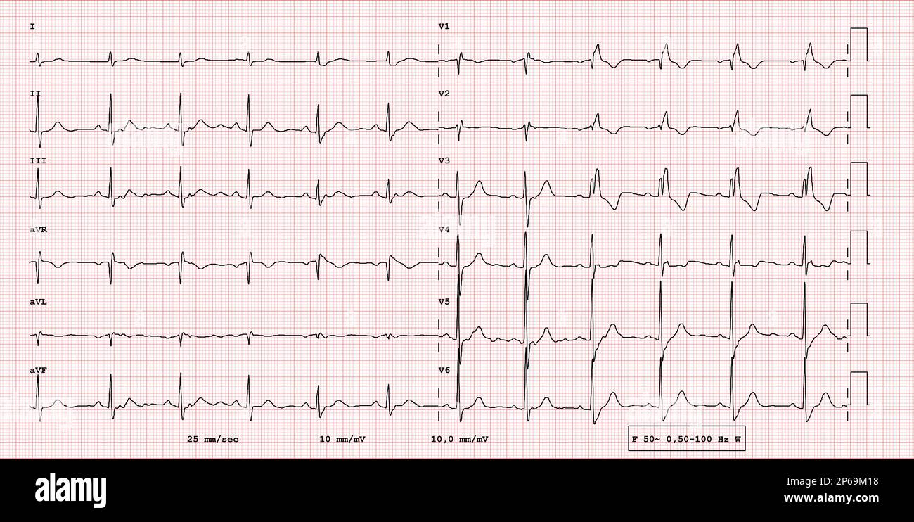 Right bundle branch block -Fotos und -Bildmaterial in hoher Auflösung ...