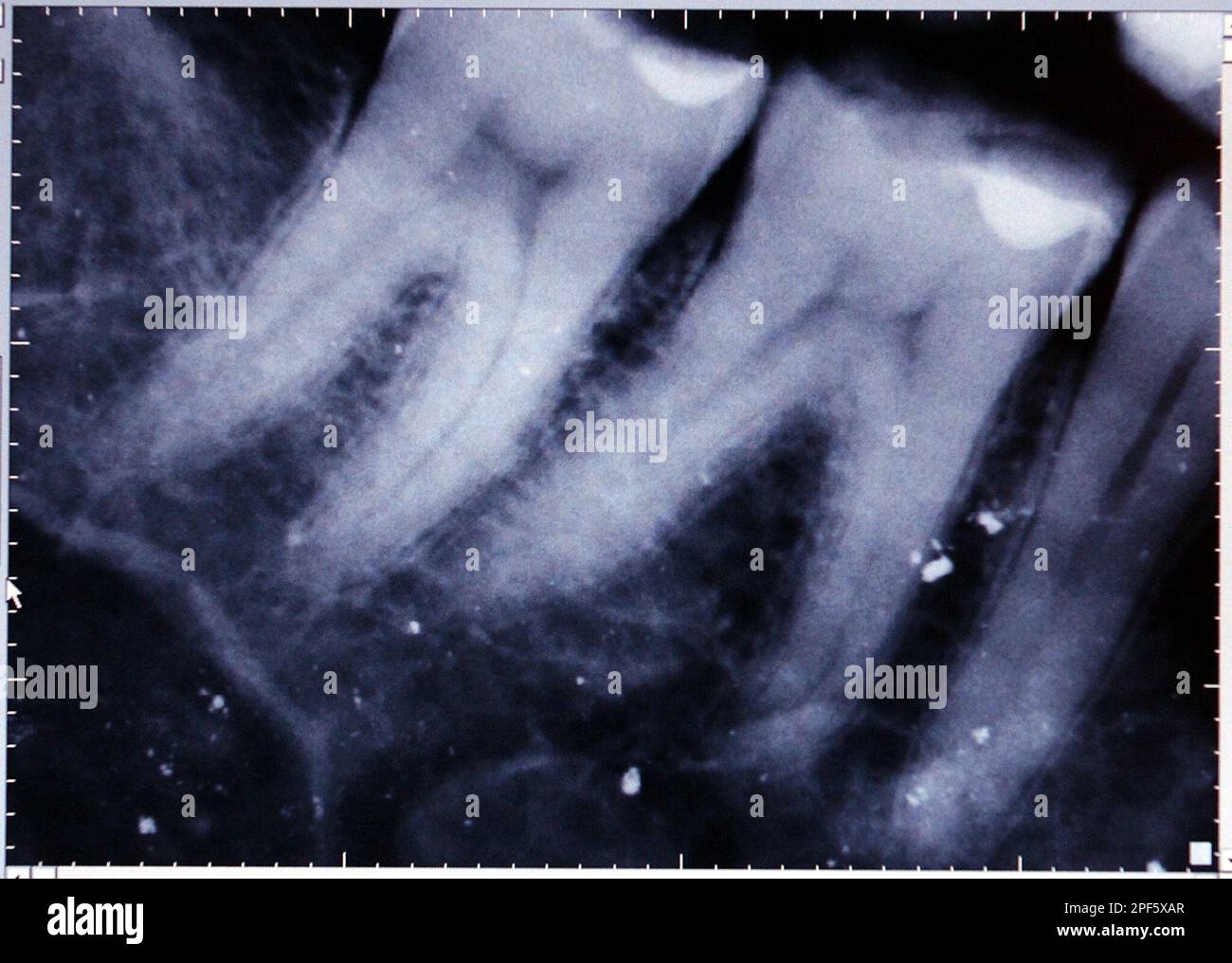 A post-mortem dental x-ray of the molars of Odai Hussein, son of ...
