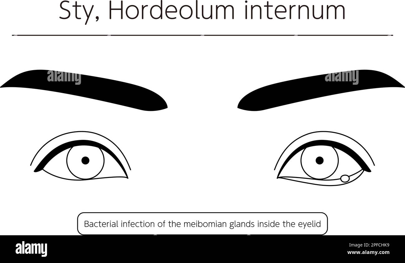Hordeolum internum -Fotos und -Bildmaterial in hoher Auflösung – Alamy