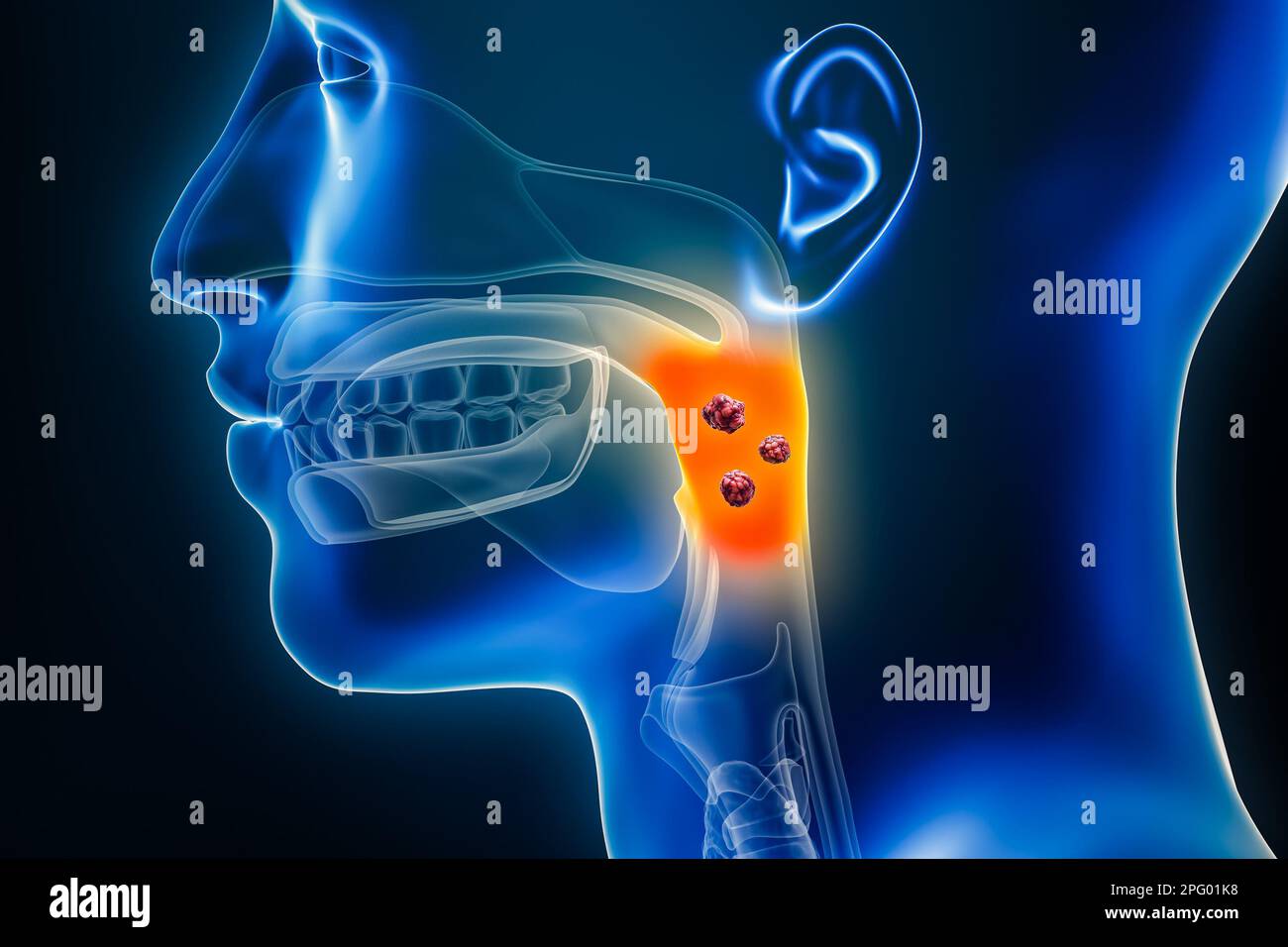 Oropharynx- oder Halskrebs mit Organen und Tumoren oder Krebszellen 3D ...