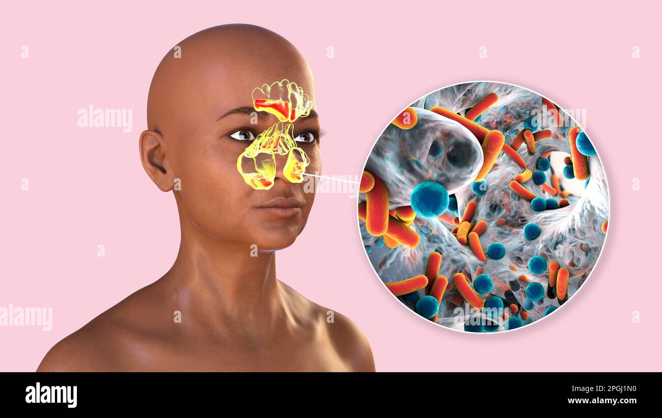 Sinusitis, Entzündung der Nasennebenhöhlen. Computerdarstellung mit ...