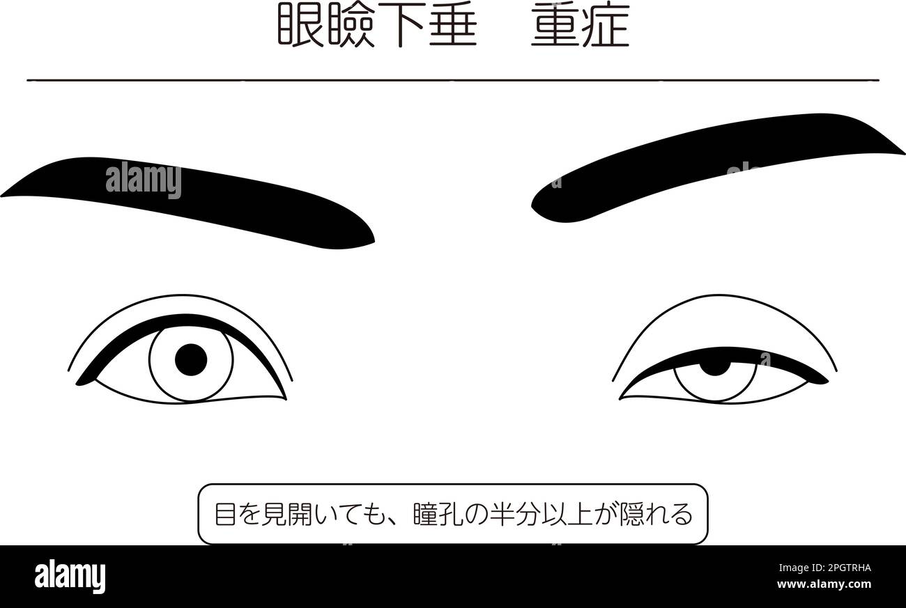 Medizinische Illustration: Diagramm einer schweren Ptosis ... Medizinische Illustration: Diagramm einer schweren Ptosis ...