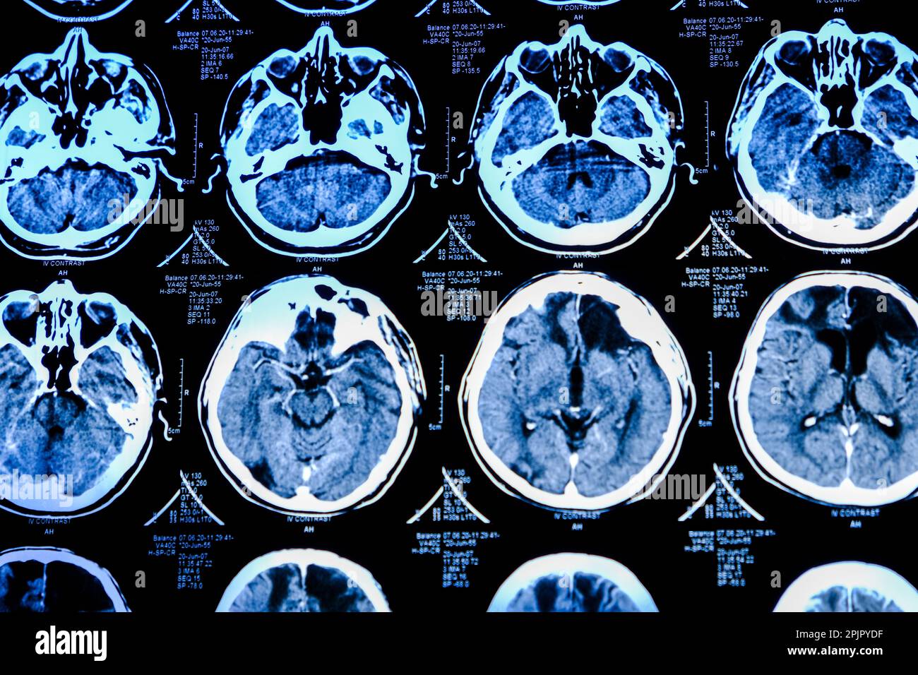 Nahaufnahme des CT-Scans mit Gehirn. Medizin, Wissenschaft und ...