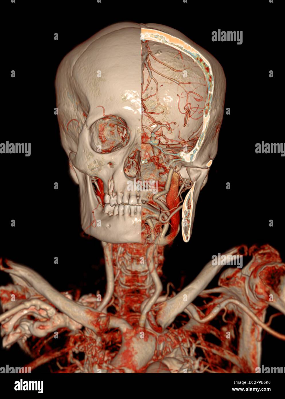 CTA Gehirn und Arteria carotis oder CT-Angiographie des Gehirns 3D ... CTA Gehirn und Arteria carotis oder CT-Angiographie des Gehirns 3D ...