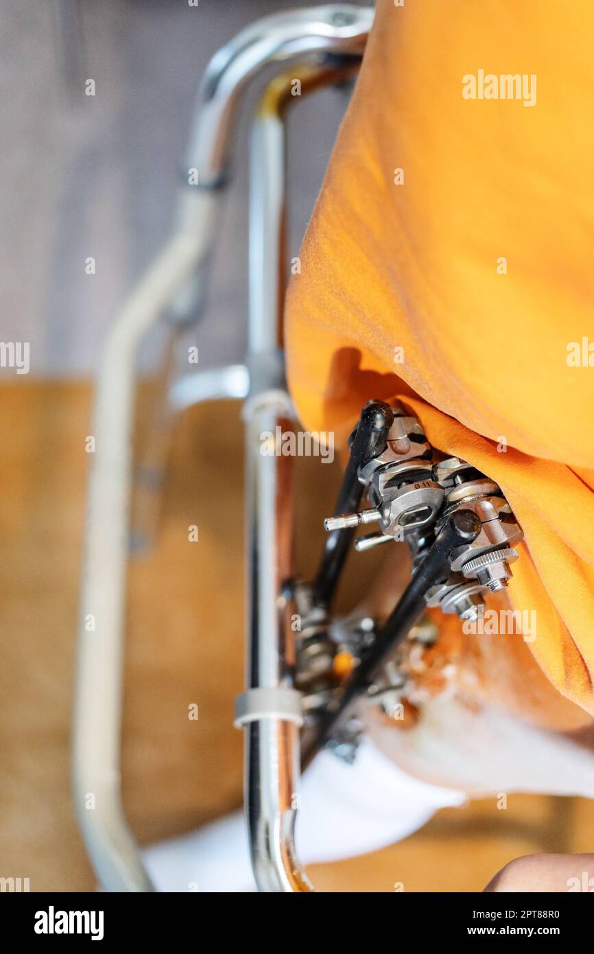 Obere Ansicht der externen Fixierungsvorrichtung an Hüfte und Becken bei Patienten mit ...