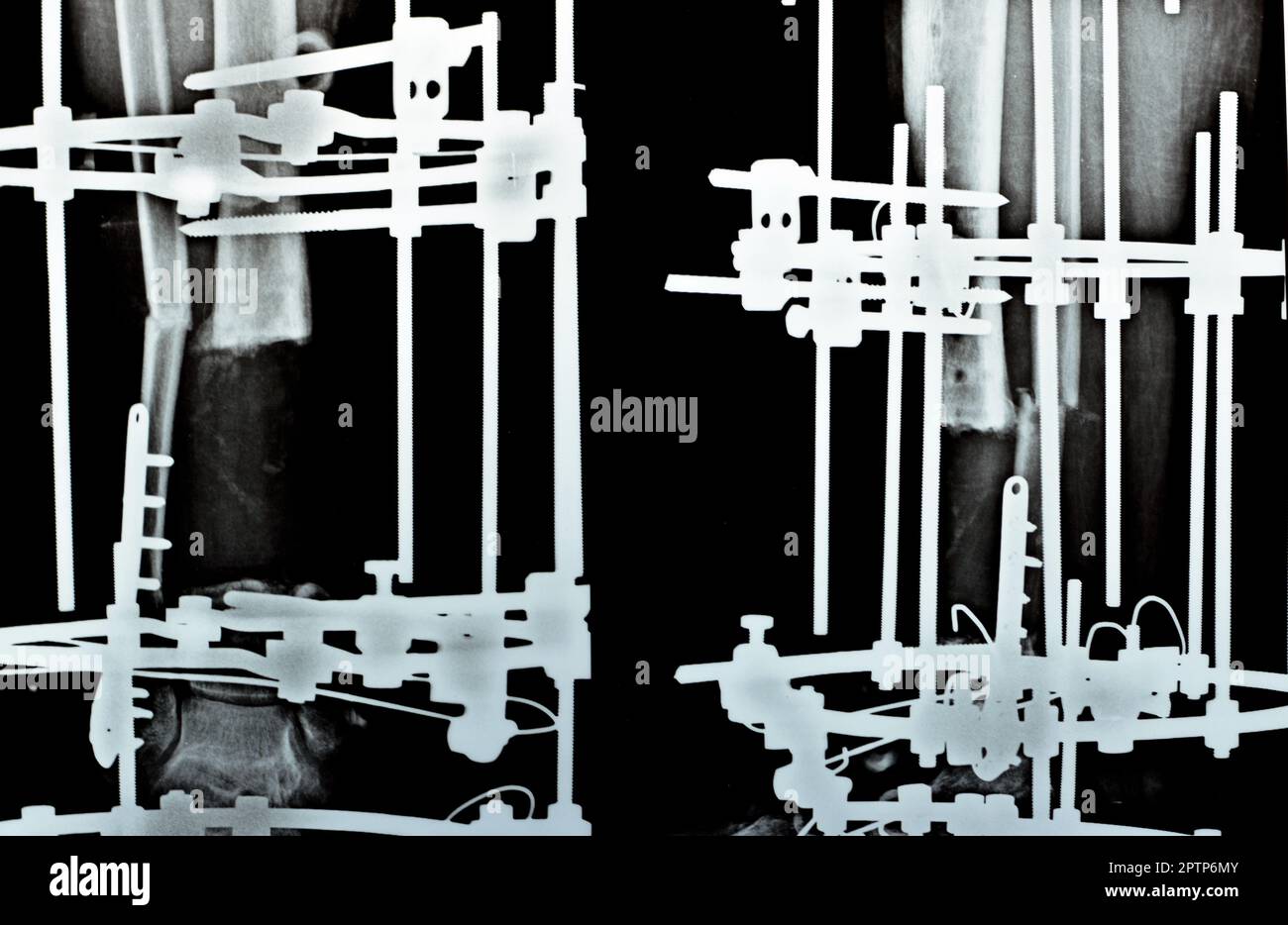 Distale fibula -Fotos und -Bildmaterial in hoher Auflösung – Alamy