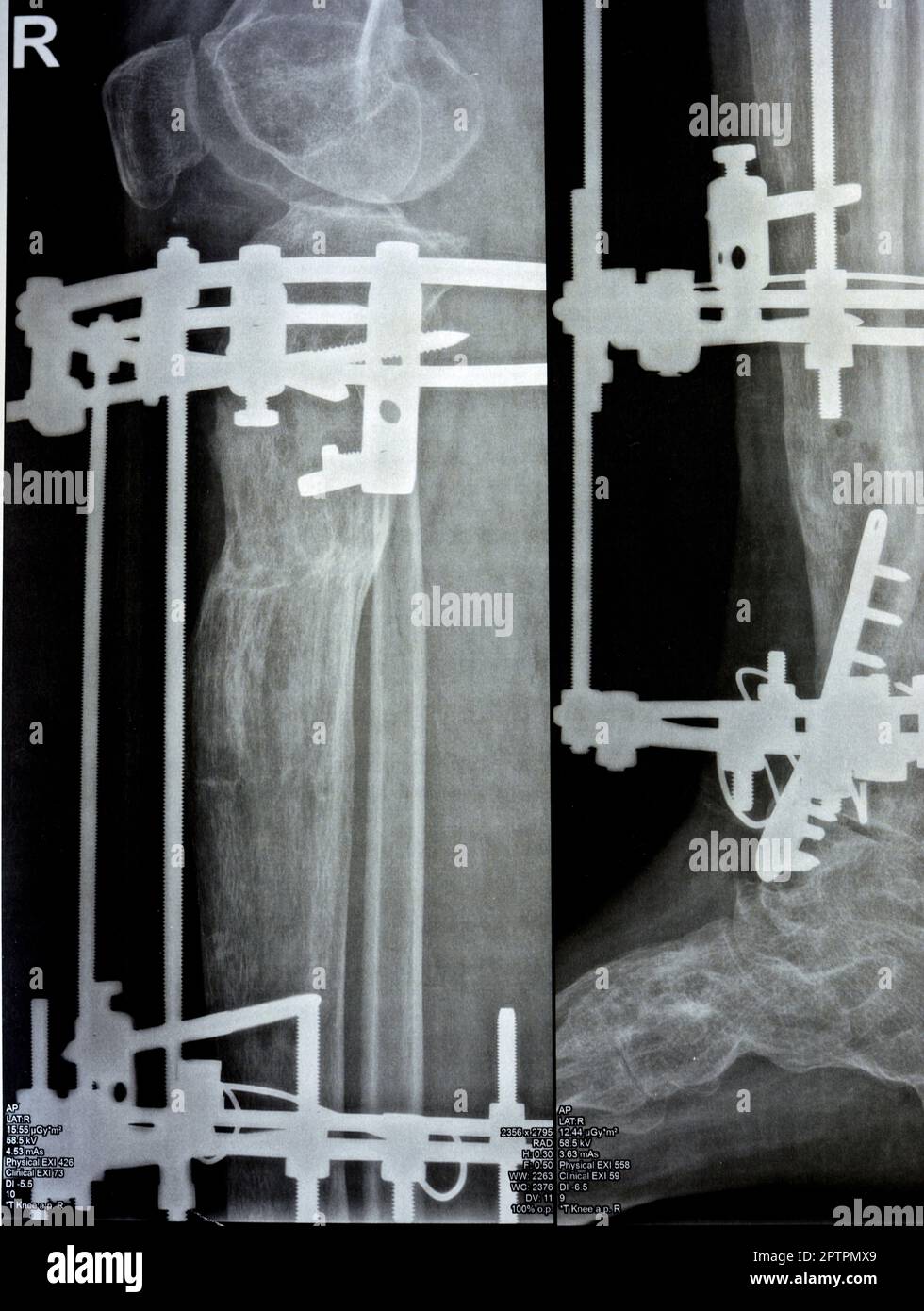Fracturas de tibia con placa y tornillo -Fotos und -Bildmaterial in ...
