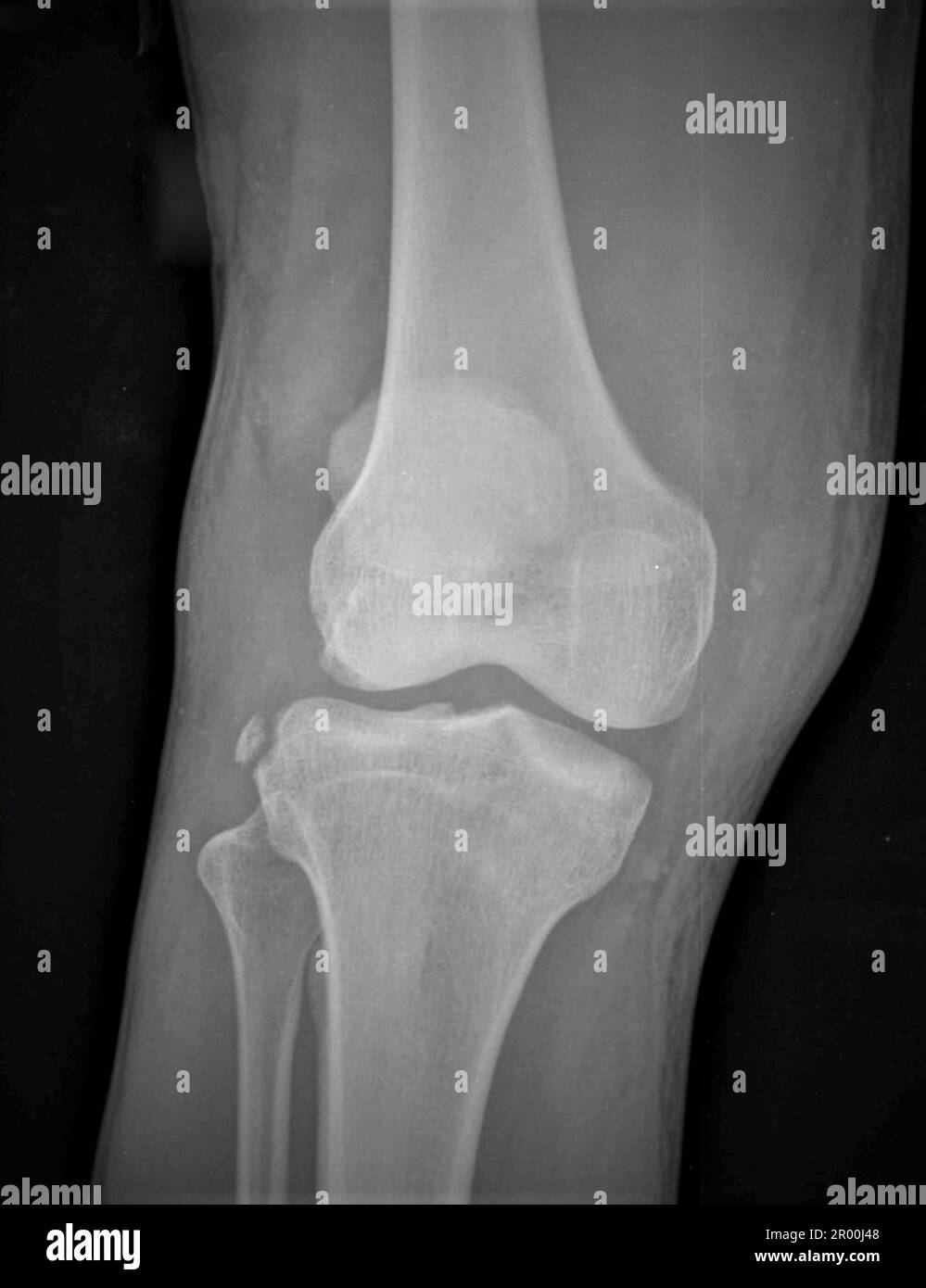 Fraktur tibia -Fotos und -Bildmaterial in hoher Auflösung – Alamy