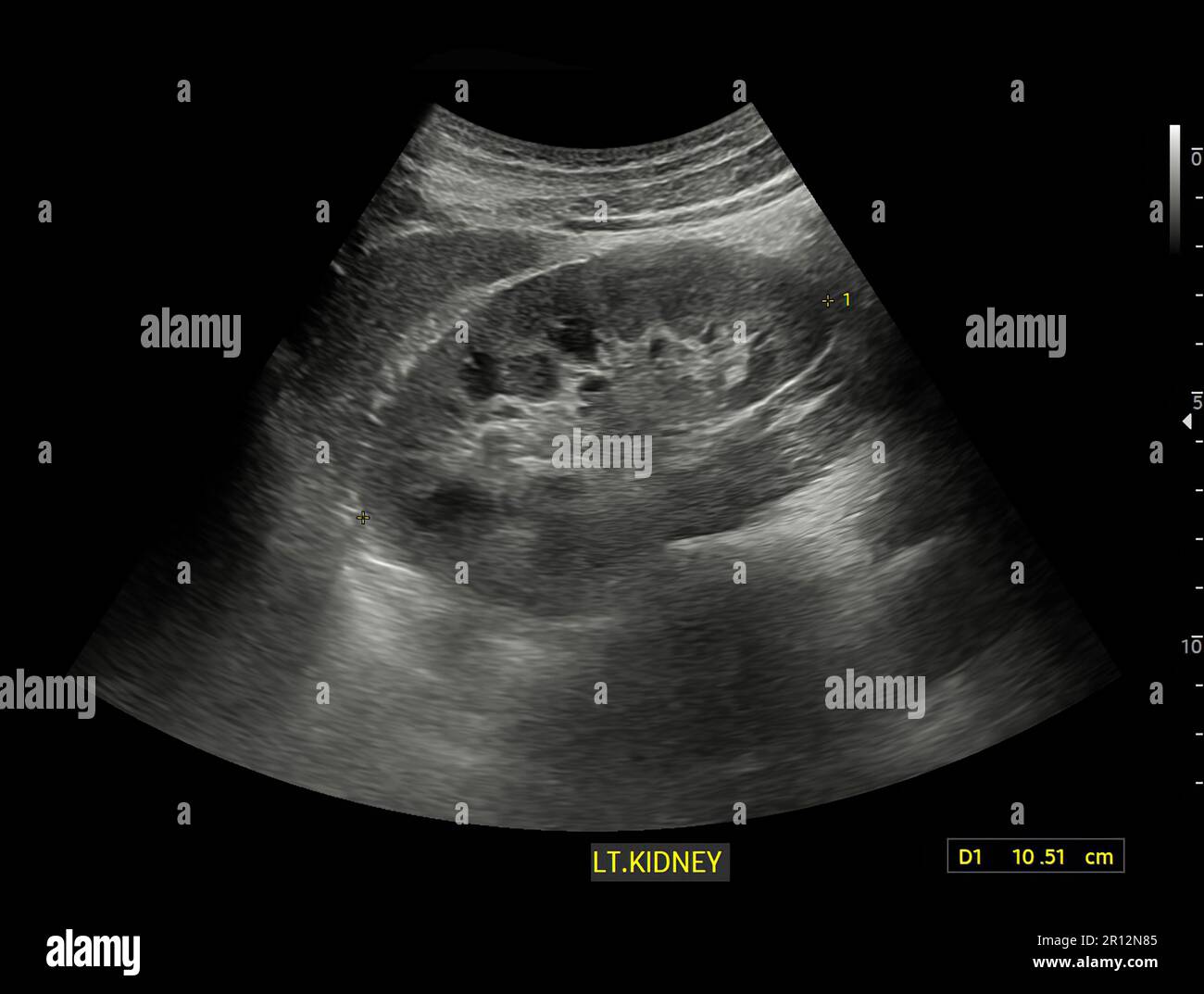 Ultraschall der Niere oder KUB zum Screening von ...