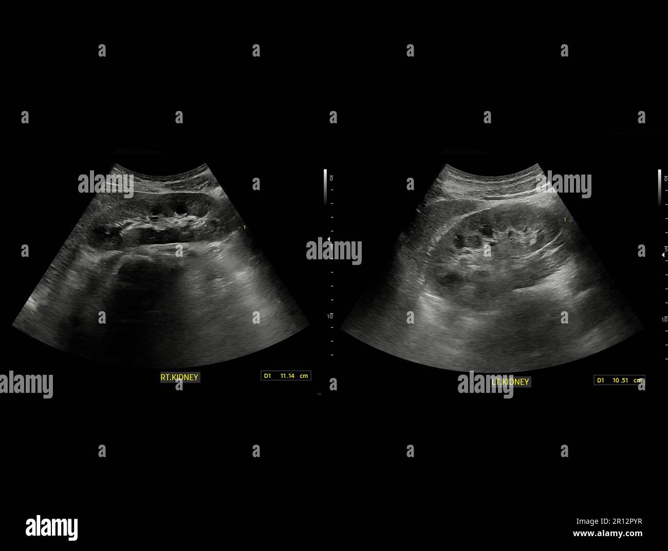 Ultraschall der Niere oder KUB zum Screening von ...