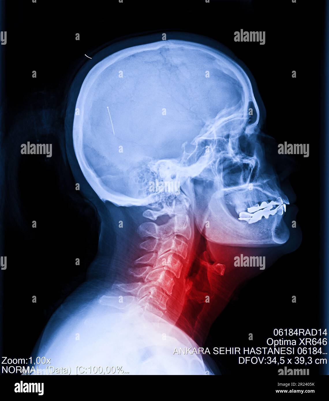 Röntgen von Hals und Halswirbelsäule. Bild einer Radiographie von ...