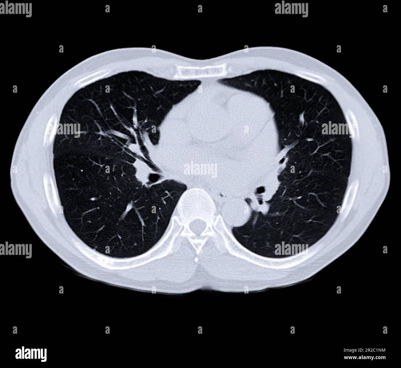 Thorax- und Lungendiagnostik mit CT-Scans zur Erfassung von Lungenrundherden und ...