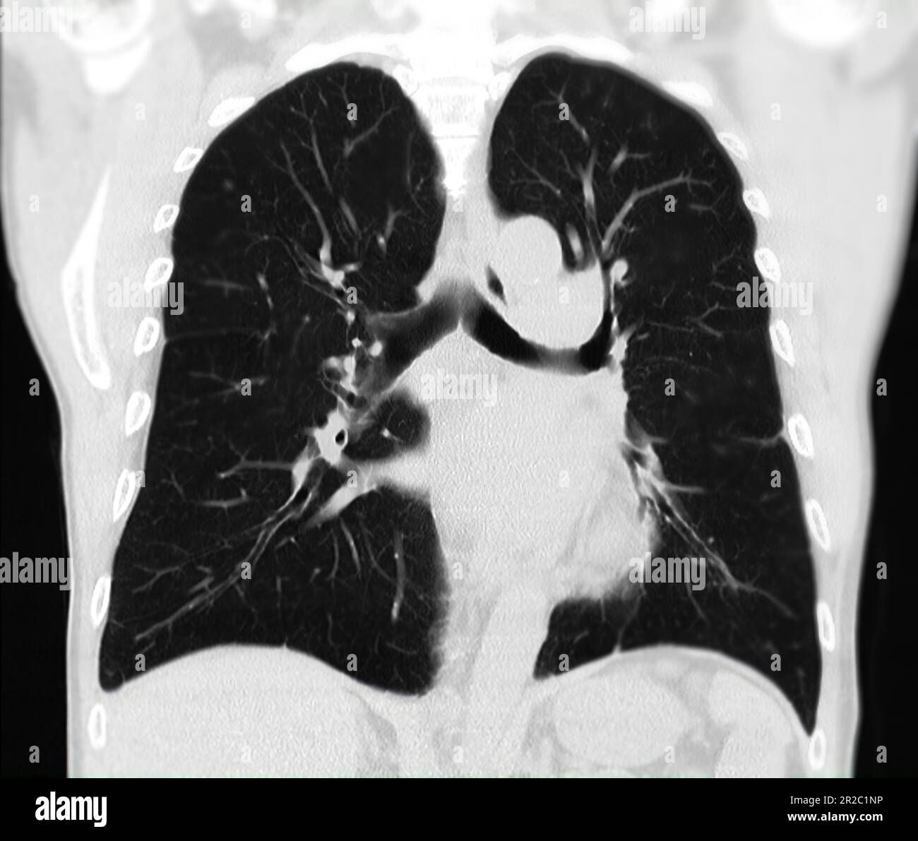 Thorax- und Lungendiagnostik mit CT-Scans zur Erfassung von ...