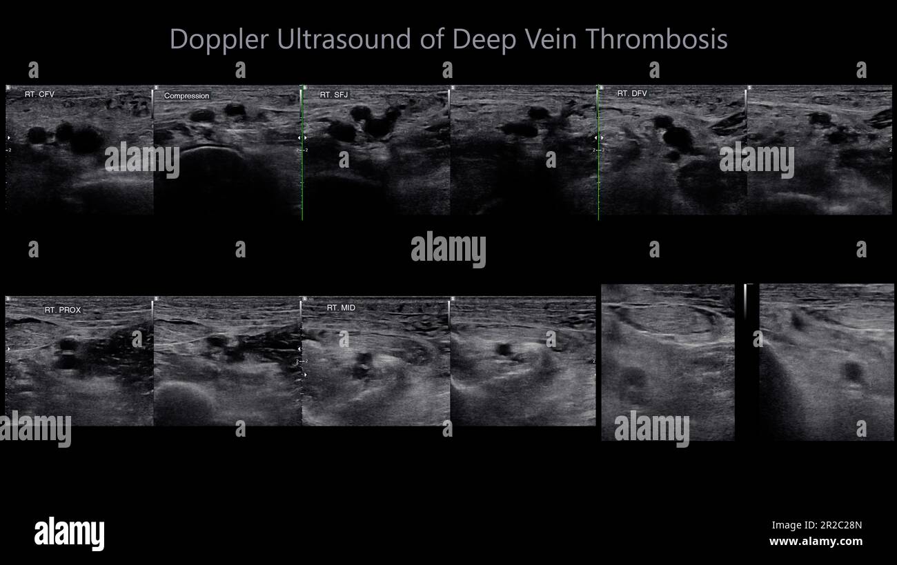 Farbdopplersonographische Bestimmung bei Patienten mit tiefer ...