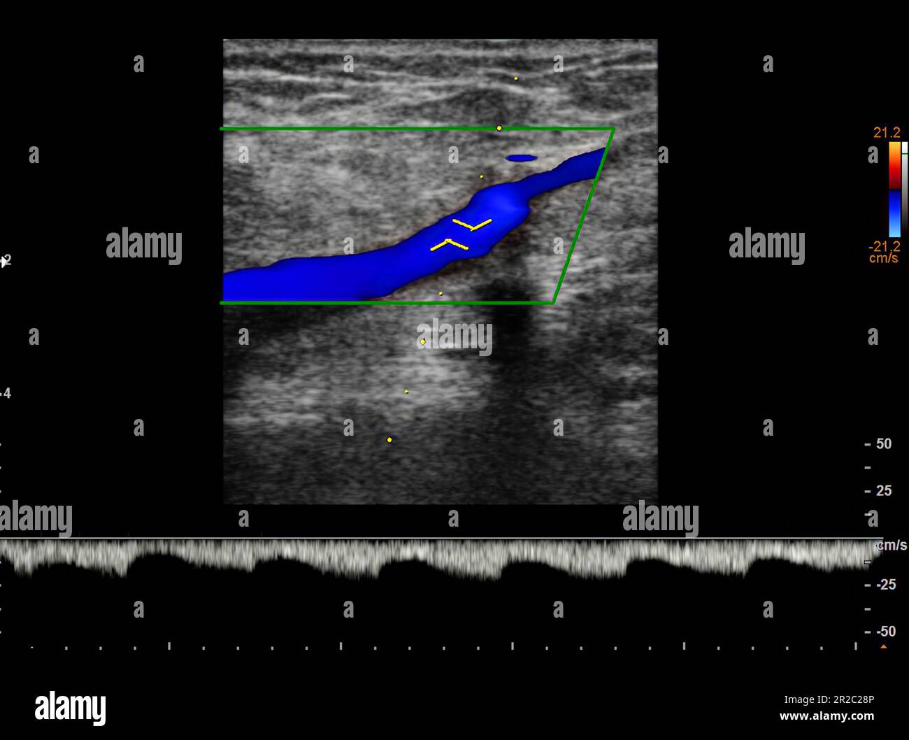 Farbdopplersonographische Bestimmung bei Patienten mit tiefer ...