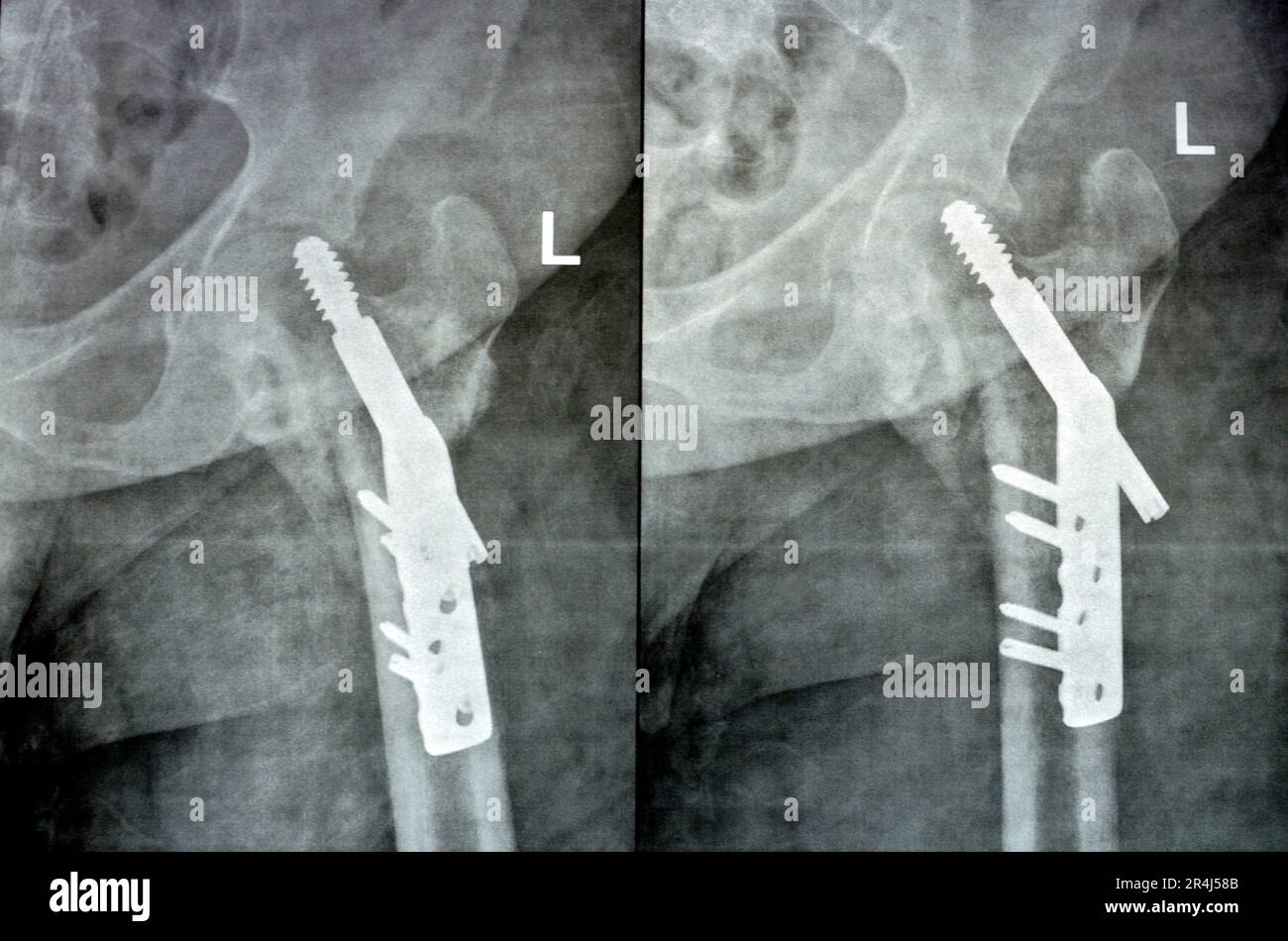 Fractura del cuello femoral -Fotos und -Bildmaterial in hoher Auflösung ...