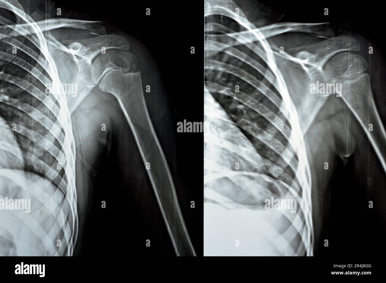 Radiografia de torax niño -Fotos und -Bildmaterial in hoher Auflösung ...