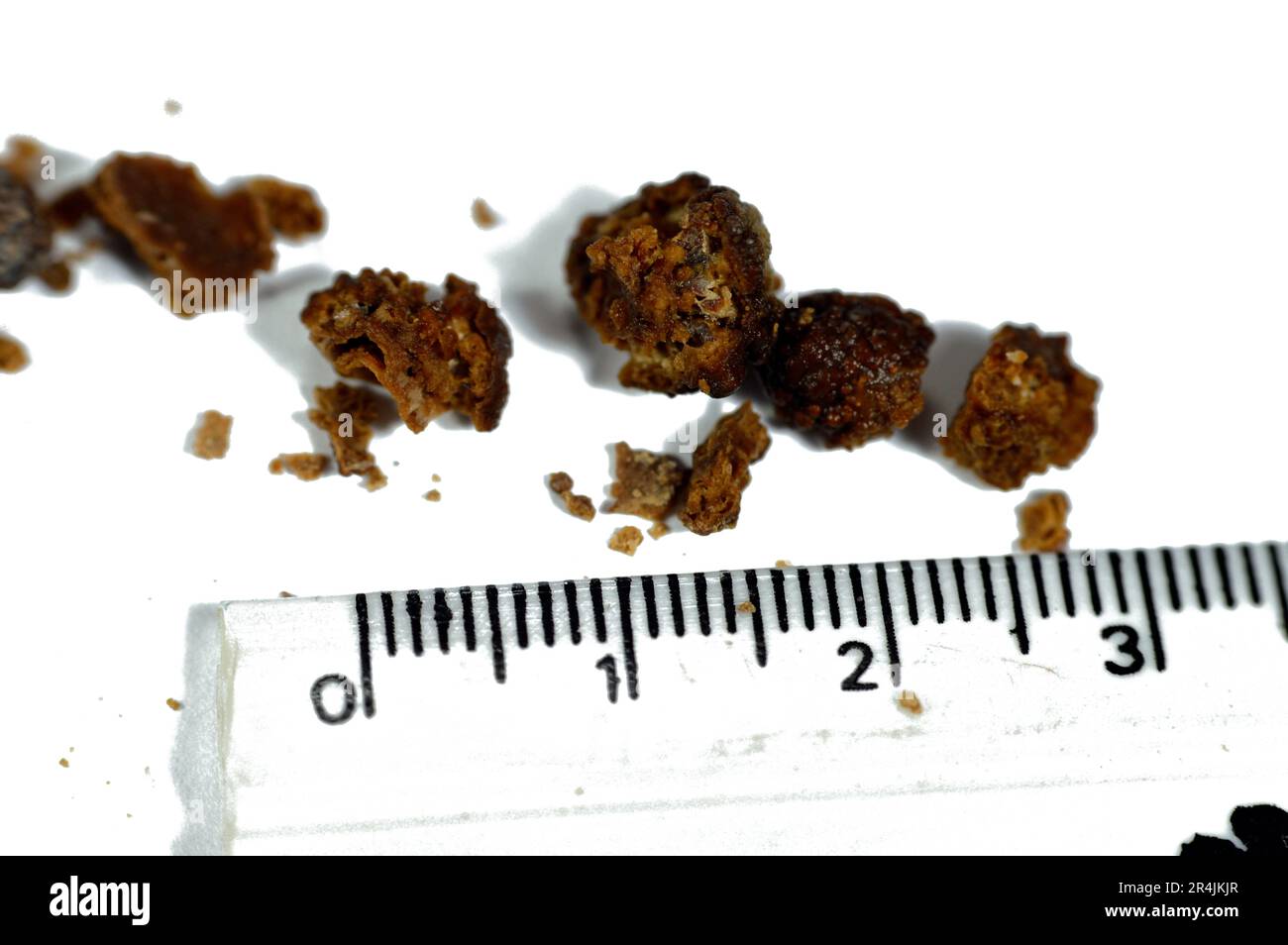 Nephrolithiasis, unregelmäßige braune Nierensteine (Nierenstein oder ...