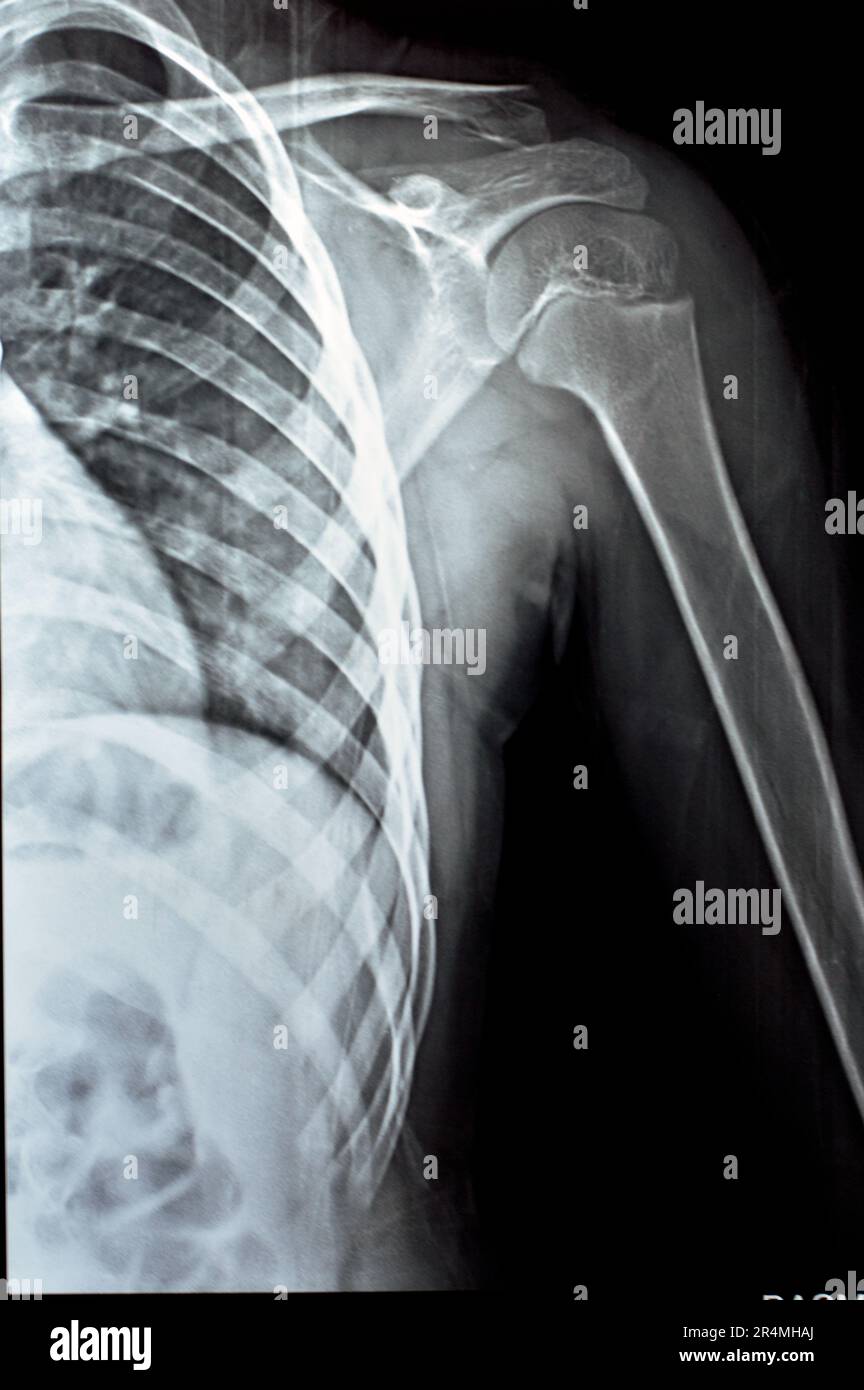 Radiografia de torax niño -Fotos und -Bildmaterial in hoher Auflösung ...