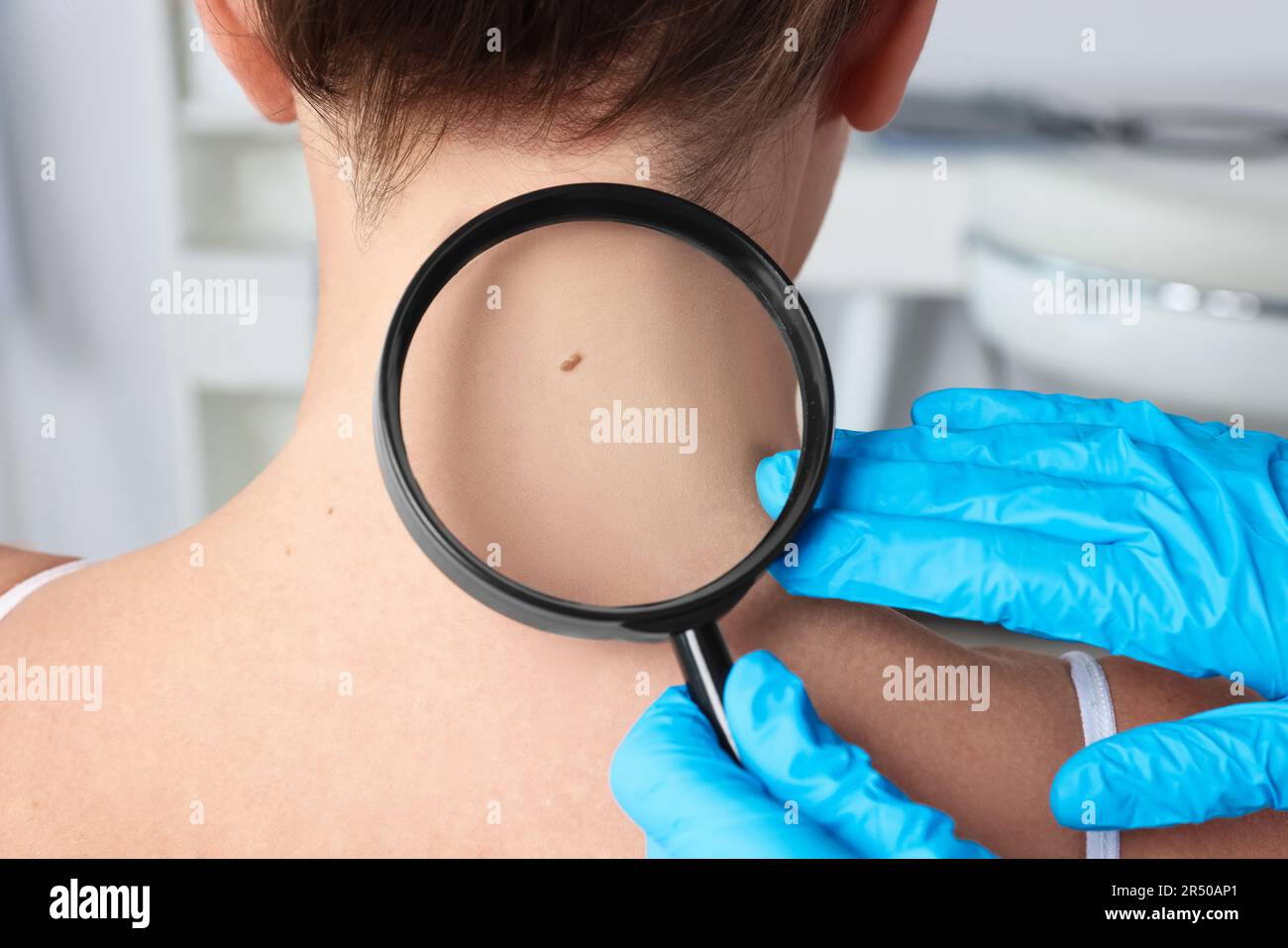 Dermatologe untersucht das Muttermal des Patienten mit Lupe in der ...