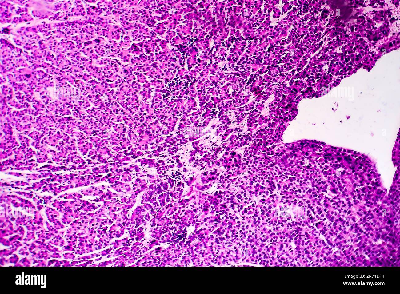 Hepatozelluläres karzinom -Fotos und -Bildmaterial in hoher Auflösung ...