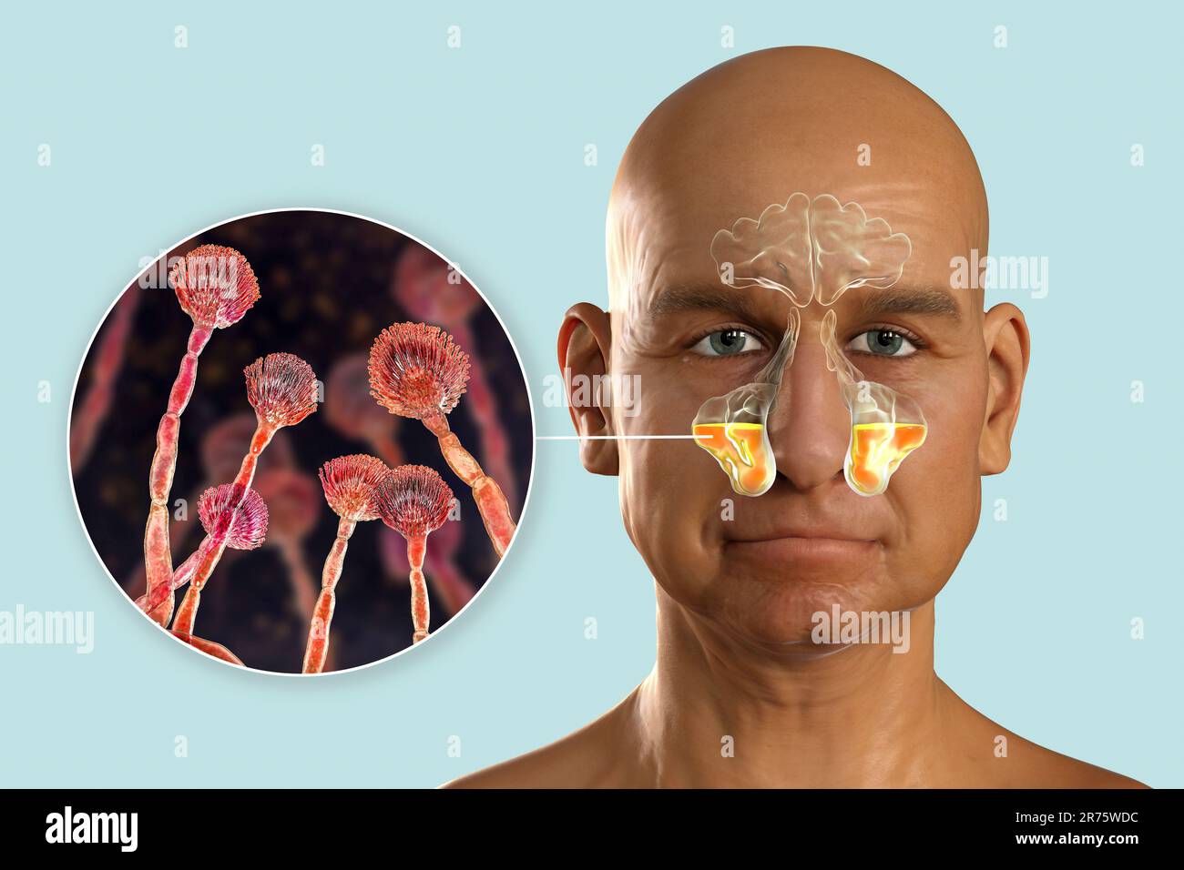Aspergillus fungi als Ursache einer Sinusitis. Computerdarstellung der ...
