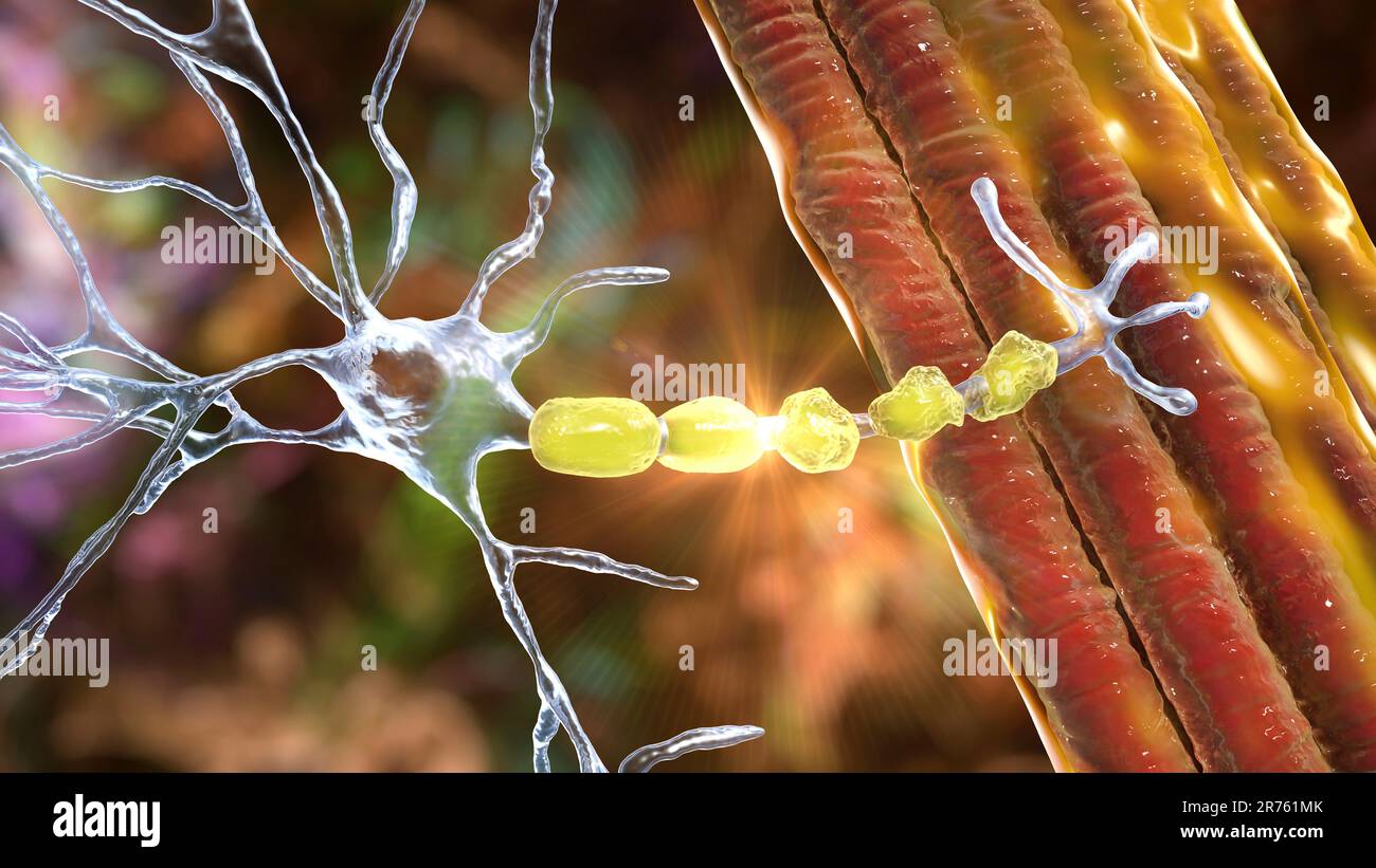 Demyelinisierung des neurons, die Schädigung der neuronenmyelinscheide ...