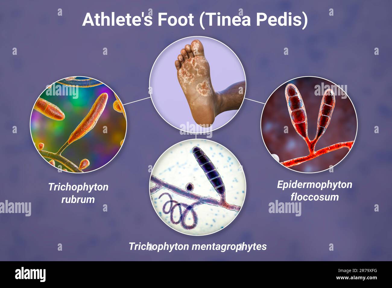 Der Fuss einer dunkelhäutigen Person mit Mykose und Nahaufnahme der ...