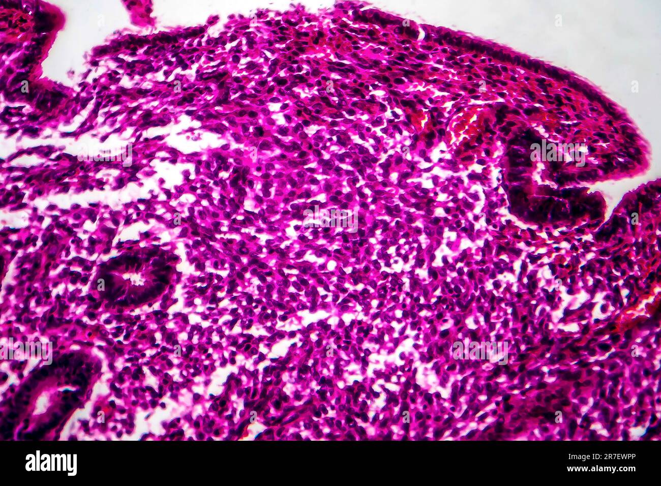 Endometriumhyperplasie. Licht Schliffbild einer Sektion durch Gewebe ...