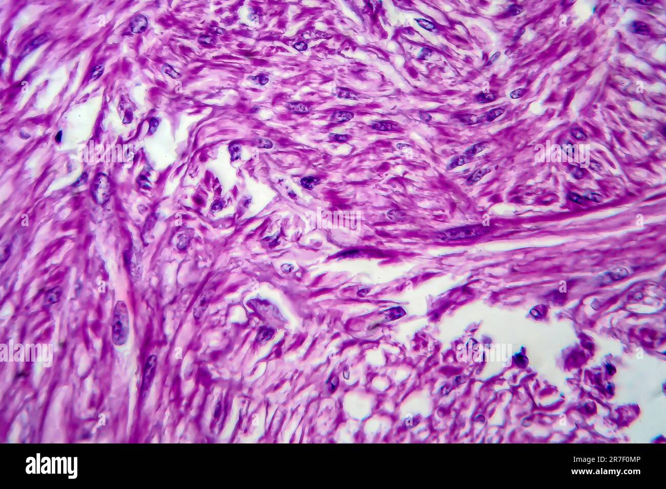 Myom leiomyom -Fotos und -Bildmaterial in hoher Auflösung – Alamy