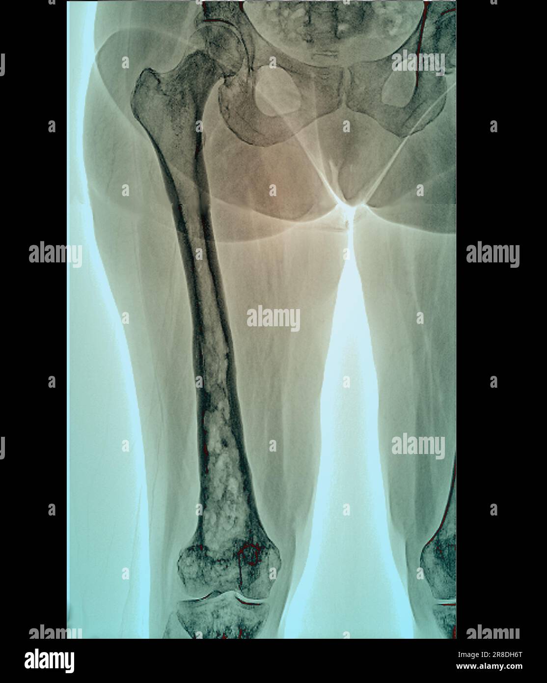 Farbiges Röntgenbild von Läsionen im Femur (Oberschenkelknochen) einer 60-jährigen Patientin mit ...