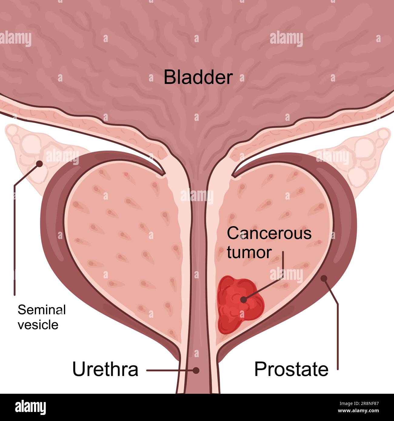 Medizinisches Diagramm des 1. Stadiums des Prostatakarzinoms. Der Tumor ...
