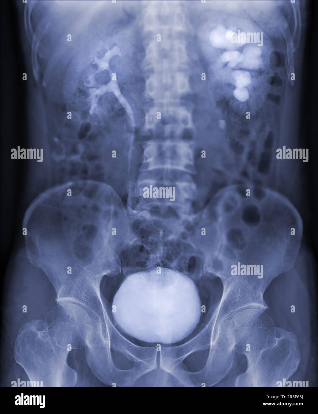 Das intravenöse Pyelogramm oder I.V.P ist eine Röntgenuntersuchung des ...