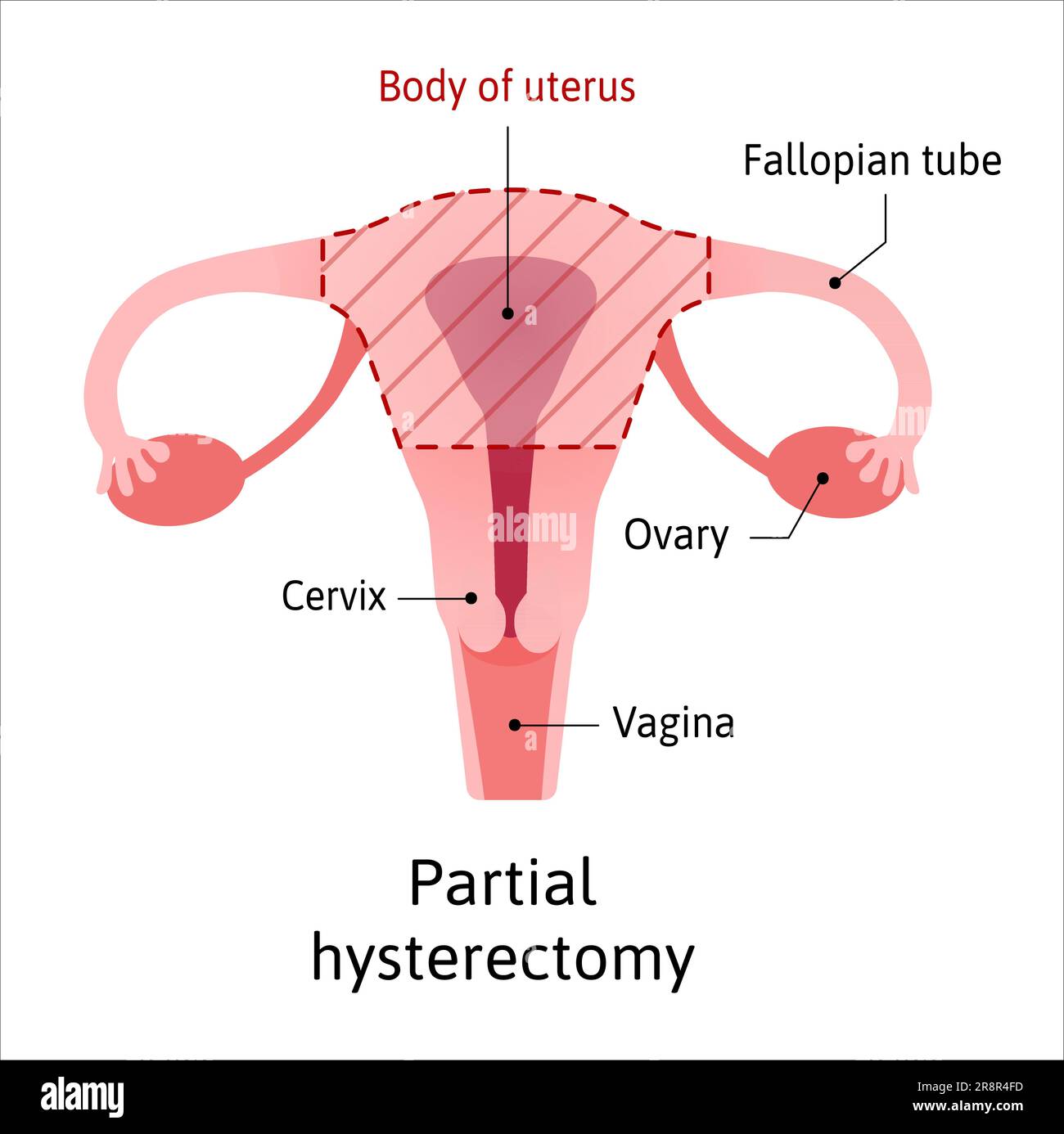 Hysterektomie, operative Entfernung des Uterus. Die medizinische Vektordarstellung zeigt eine ...