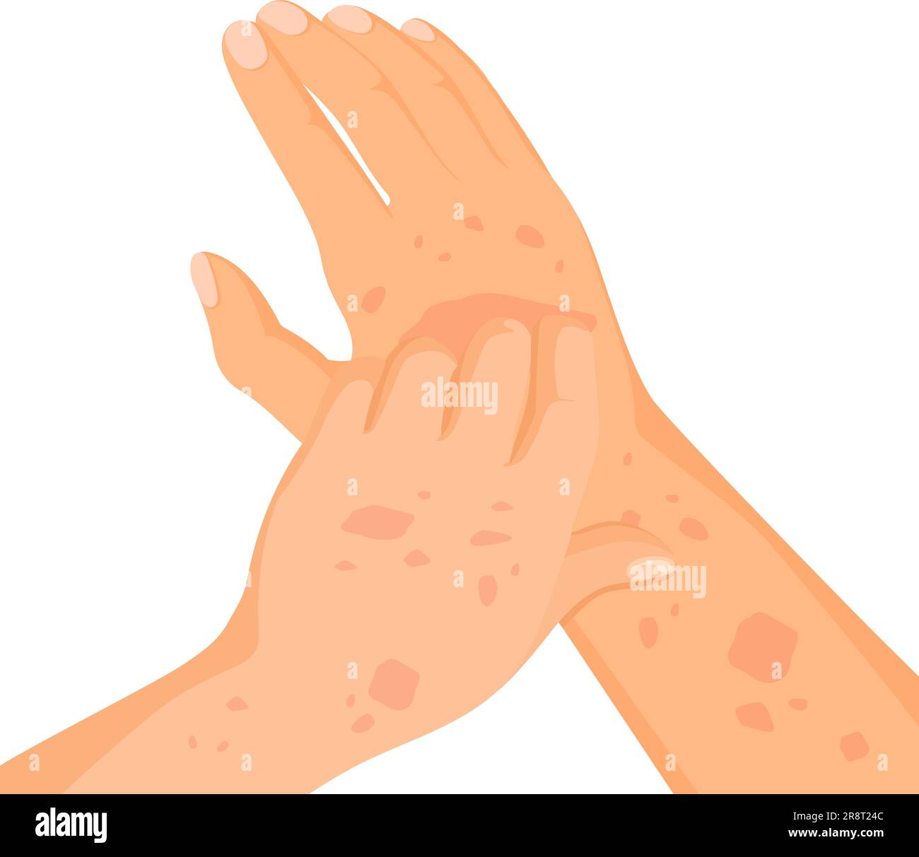 Hautausschlag an der Hand. Hautausschläge juckende Hände Kratzer Arm in ...