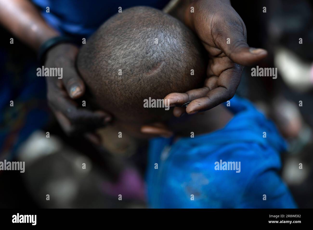 Lovely Benjamin holds the head of her 4-year-old son to show the scar ...