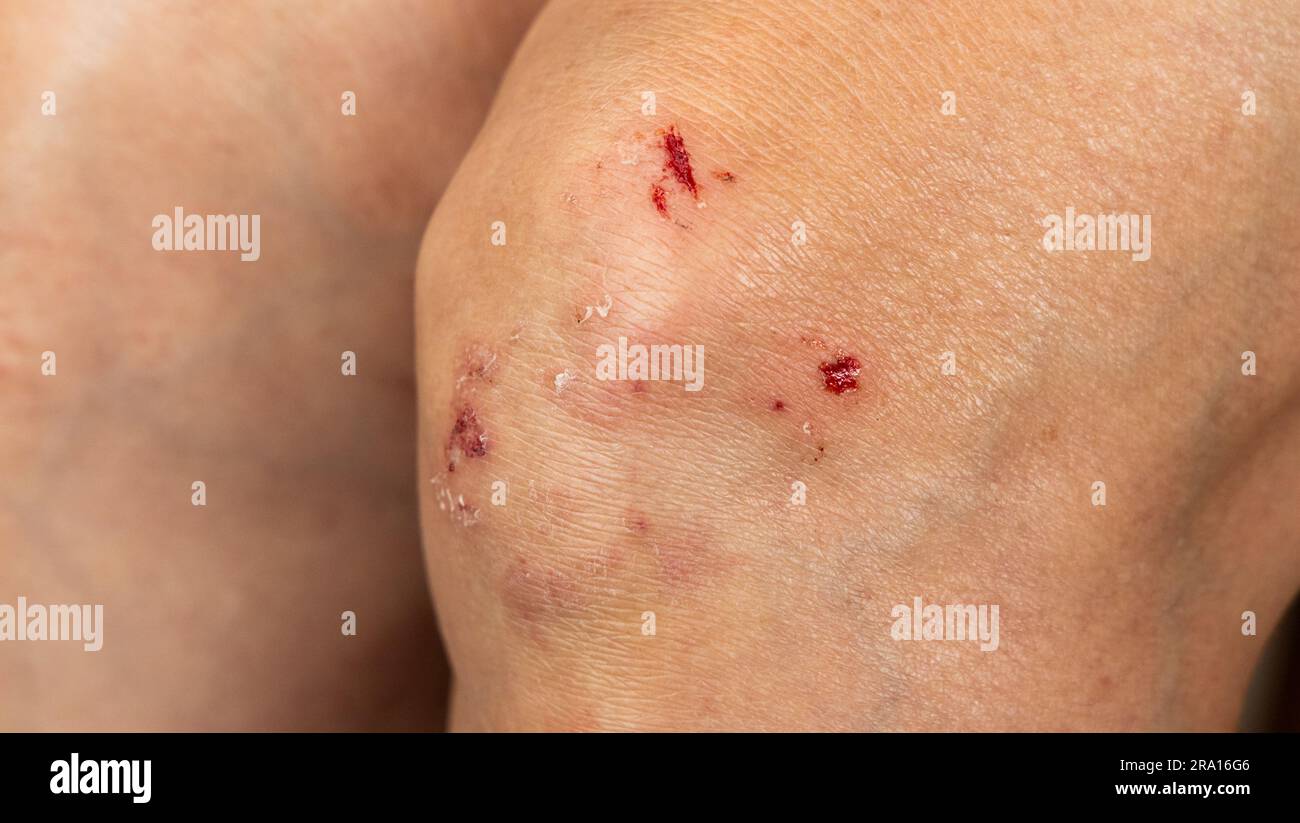 Hämatom knie -Fotos und -Bildmaterial in hoher Auflösung – Alamy
