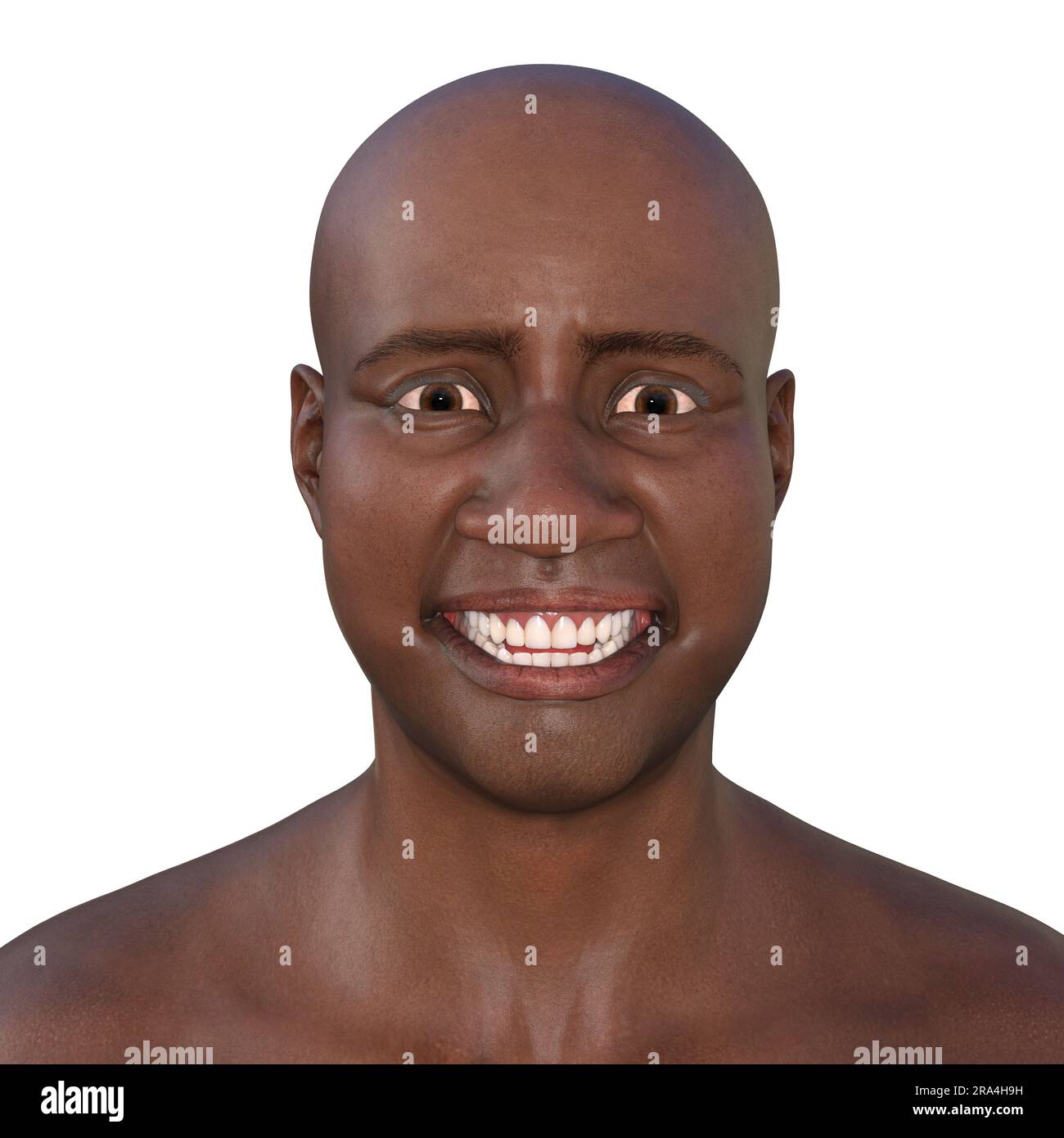 Tetanus lockjaw -Fotos und -Bildmaterial in hoher Auflösung – Alamy