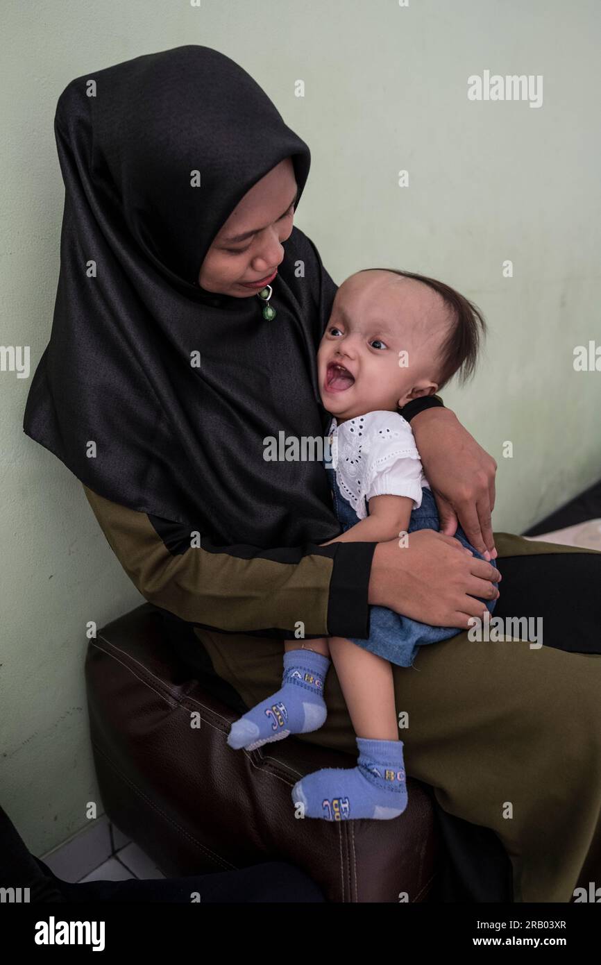 Hydrozephalus kindheit -Fotos und -Bildmaterial in hoher Auflösung – Alamy