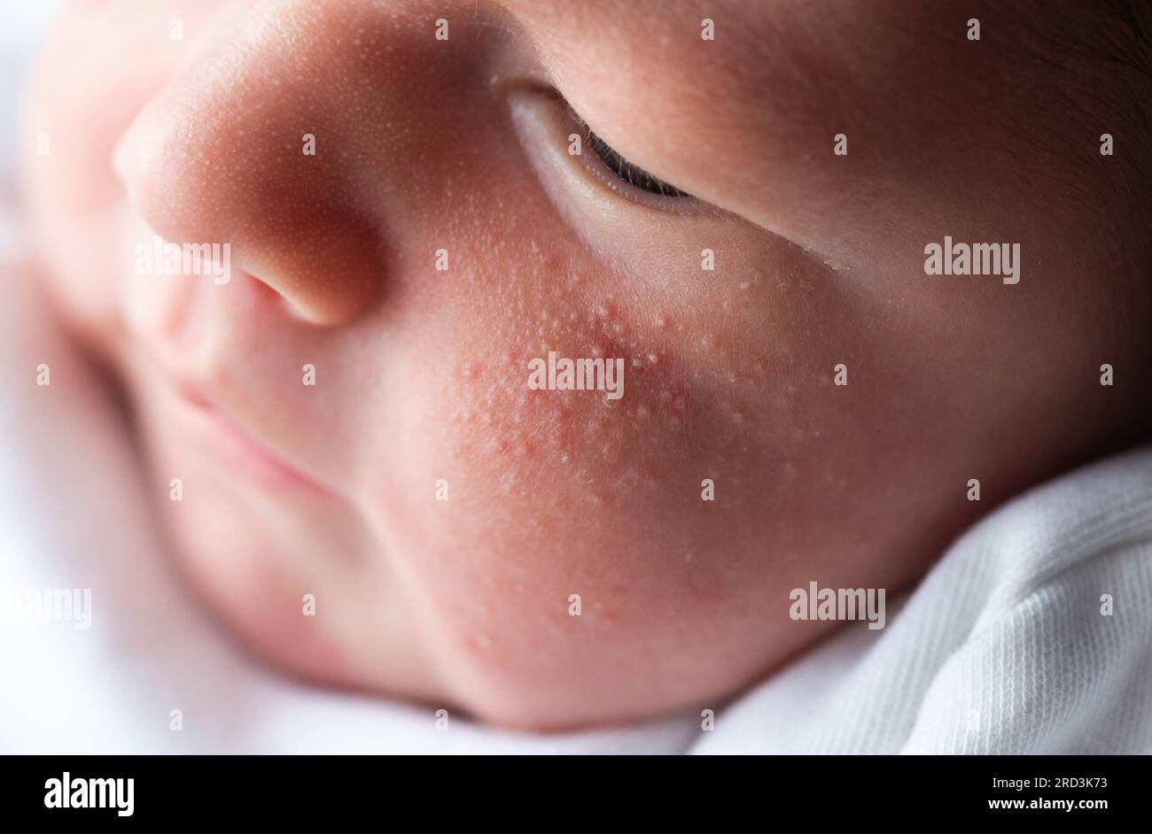 Akne bei neugeborenen -Fotos und -Bildmaterial in hoher Auflösung – Alamy