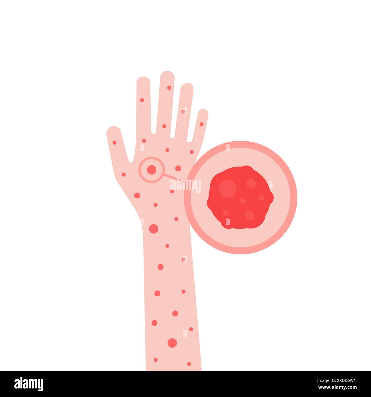 Scabies wound Stock-Vektorgrafiken kaufen - Alamy