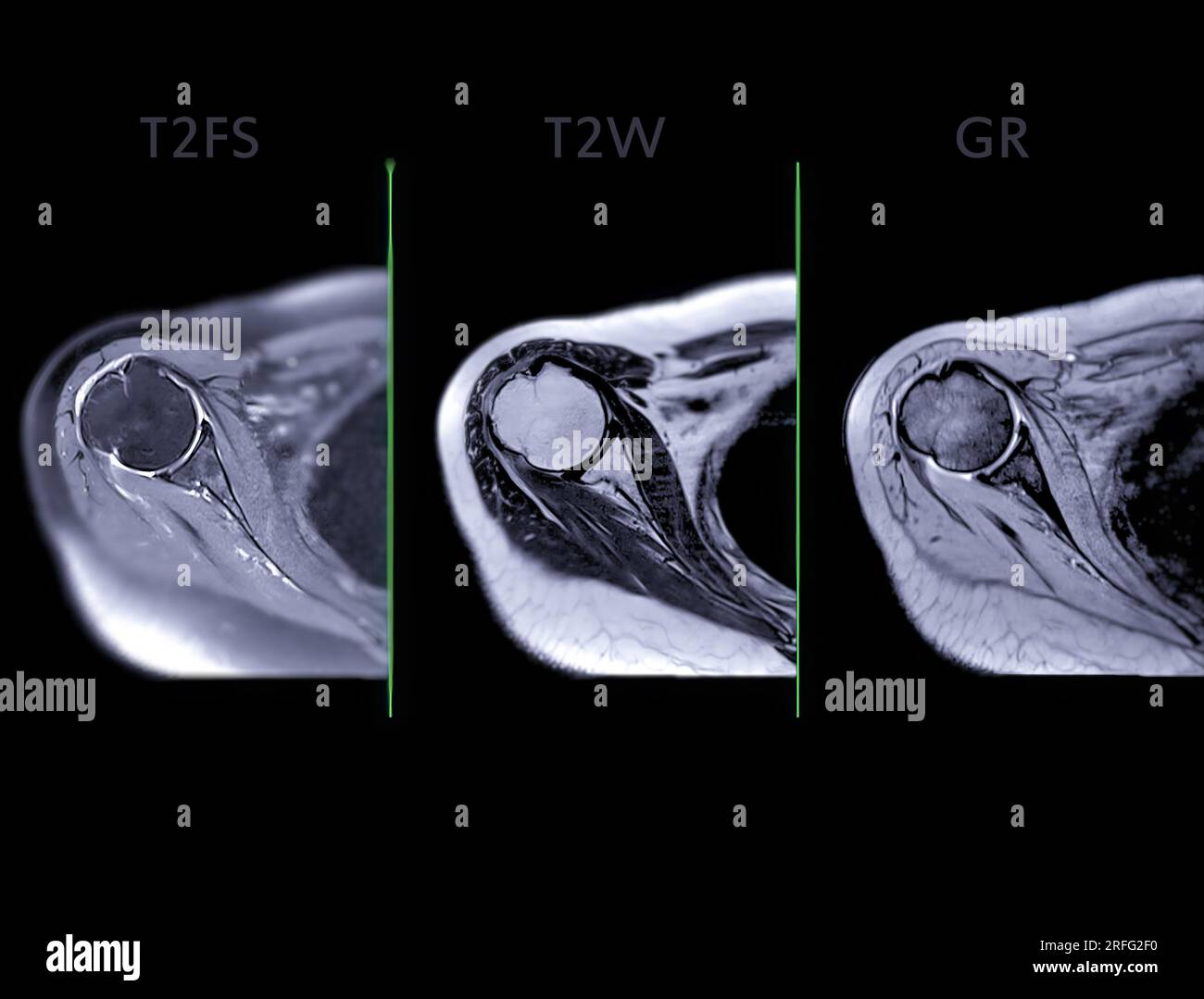 Magnetresonanztomographie oder MRT des Schultergelenkes Axial T2FS,T2W ...